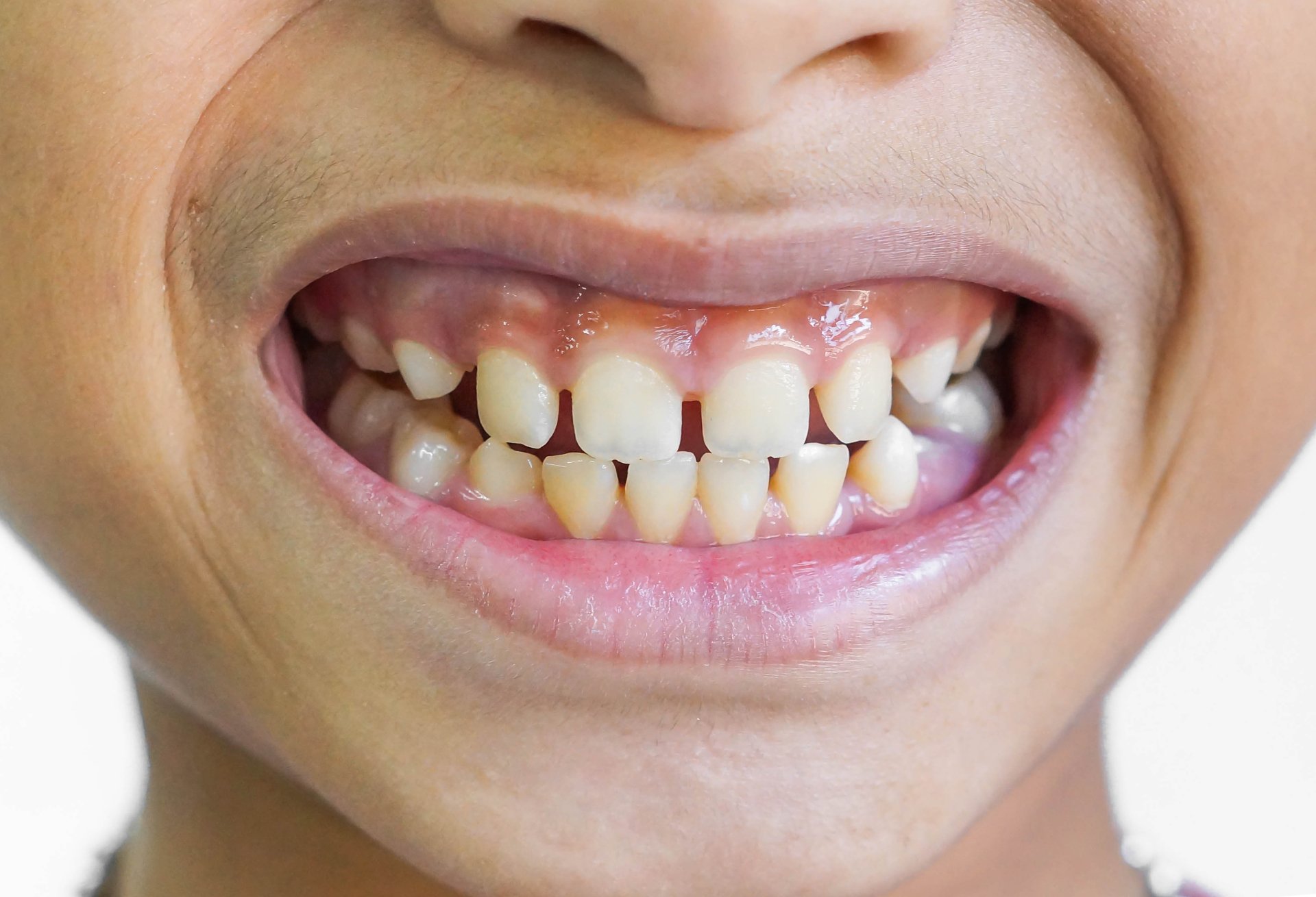 Diastema (Gap Between Teeth) Treatment | Dental Treatment in Turkey ...